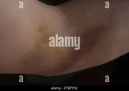 Closeup young man hand with bruise after injection Stock Photo - Alamy