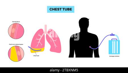Chest tube catheter, illustration Stock Photo - Alamy