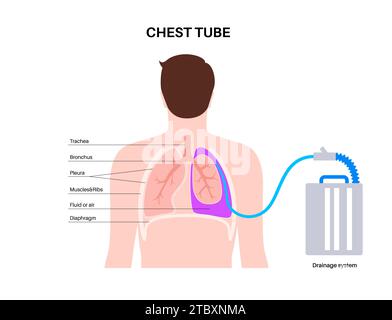 Chest tube catheter, illustration Stock Photo - Alamy