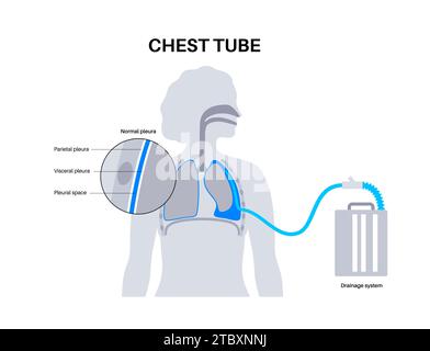 Chest tube catheter, illustration Stock Photo - Alamy