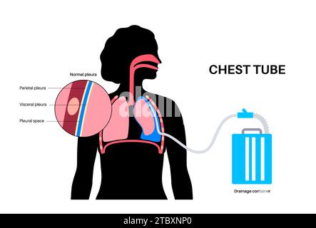 Chest tube catheter, illustration Stock Photo - Alamy