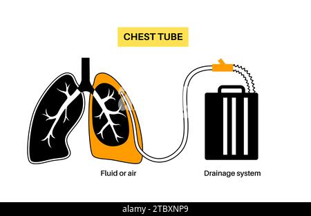 Chest tube catheter, illustration Stock Photo - Alamy