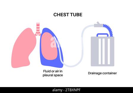 Chest tube catheter, illustration Stock Photo - Alamy