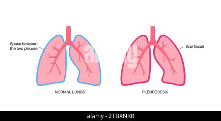 Pleurodesis medical procedure, illustration Stock Photo - Alamy