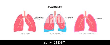 Pleurodesis medical procedure, illustration Stock Photo - Alamy