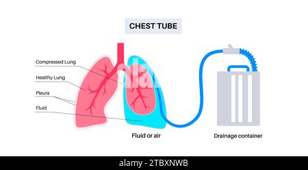 Chest tube catheter, illustration Stock Photo - Alamy