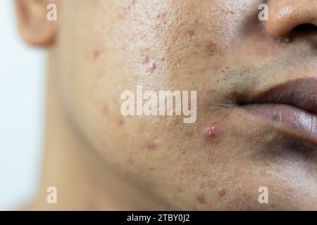 skin problems. problem of inflamed acne on the face. Inflamed acne ...