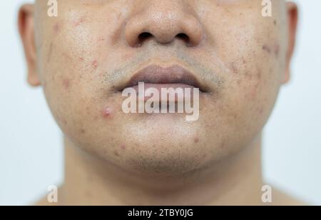 skin problems. problem of inflamed acne on the face. Inflamed acne ...