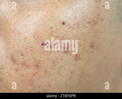 skin problems. problem of inflamed acne on the face. Inflamed acne ...