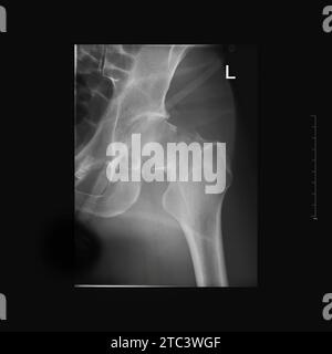 Left femoral neck fracture. Roentgenogram. Next day after total hip ...