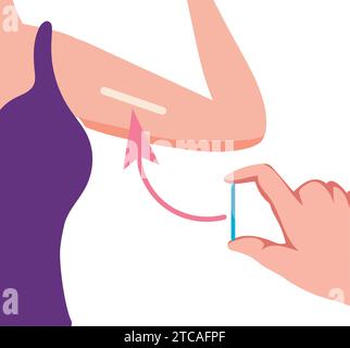 contraceptive implant birth control Stock Vector Image & Art - Alamy