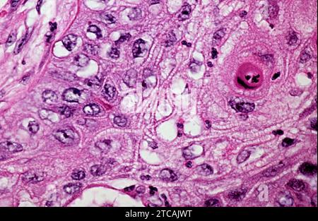 Well-differentiated squamous cell carcinoma of the back of the dorsal ...