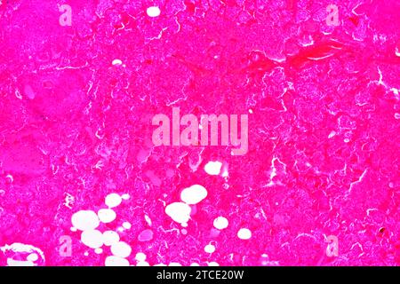Human tuberculosis lung section. Optical microscope X100 Stock Photo ...