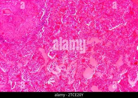 Human tuberculosis lung section. Optical microscope X100 Stock Photo ...