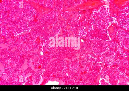 Human tuberculosis lung section. Optical microscope X100 Stock Photo ...