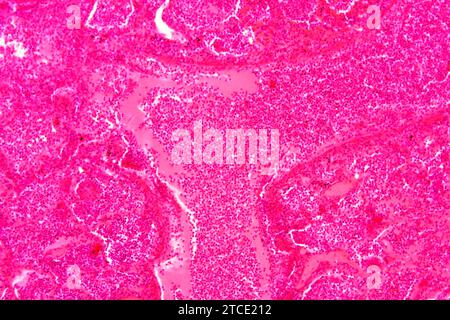 Human tuberculosis lung section. Optical microscope X100 Stock Photo ...