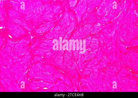 Human uterine fibroid (benign tumor). Optical microscope X40 Stock ...