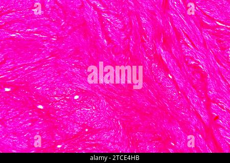 Human uterine fibroid (benign tumor). Optical microscope X100 Stock ...