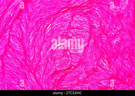 Human uterine fibroid (benign tumor). Optical microscope X40 Stock ...