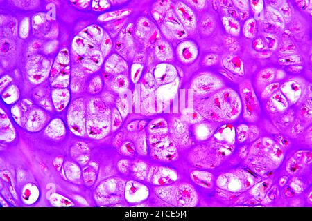 Human pubic bone chondrosoma (benign tumor) showing chondrocytes and ...