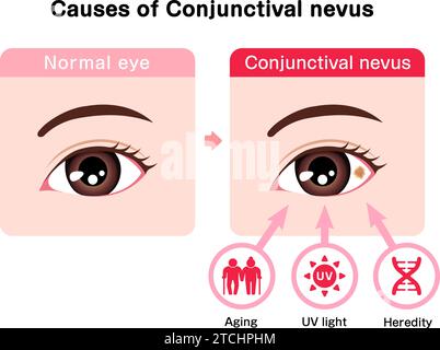 Causes of Conjunctival nevus vector illustration Stock Vector Image ...