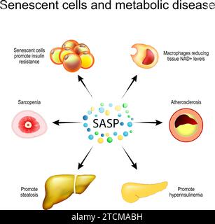 Sarcopenia. Age-related muscle atrophy. Comparison and Difference ...