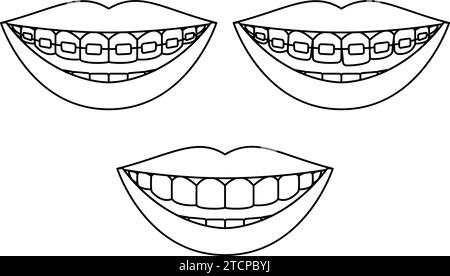 Teeth with metal brackets in cosmetic dentistry and orthodontics ...