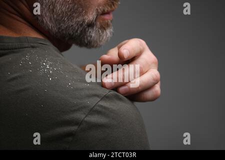 Bearded man brushing dandruff off his t-shirt on grey background ...
