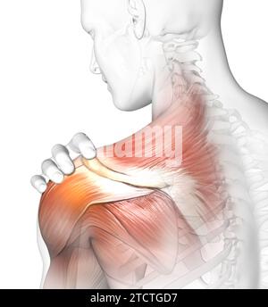 Illustration of shoulder tendonitis. Inflammation of the rotator cuff ...