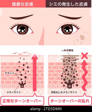 Vector illustration of how skin spots (hyperpigmentation) are created ...
