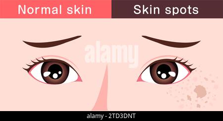 Vector illustration of normal skin turnover Stock Vector Image & Art ...