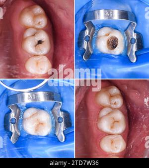 before and after picture of dental ceramic restoration on teeth and ...