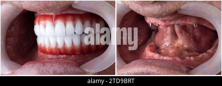 zircon bridge restoration on implants Stock Photo - Alamy