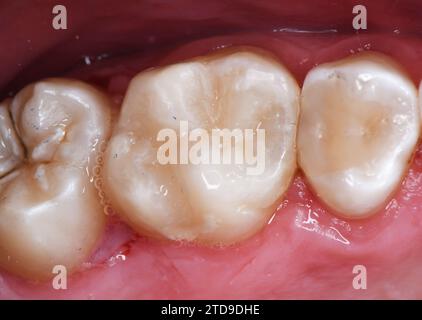 caries treatment by dental direct filling restoration Stock Photo - Alamy