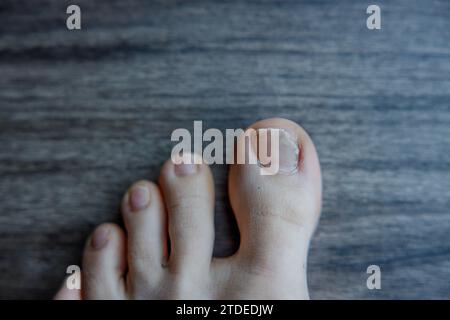 View of partial detachment of the toenail from the nail bed due to ...