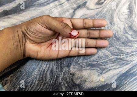 cut wound at the thumb with Blood on the finger of the hand and blurred ...