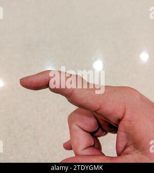 X-ray of a broken metacarpal (finger joint nearest the wrist bones, or ...