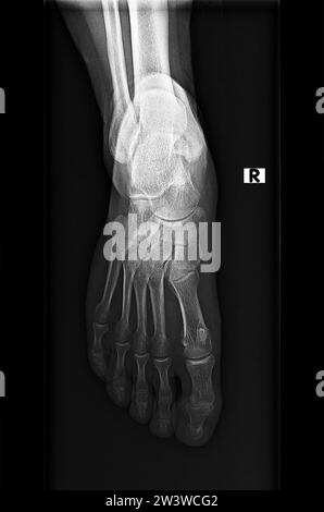 Normal radiography, xray or x-ray of the foot and ankle joint in ...