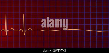 Asystole cardiac arrest, illustration Stock Photo - Alamy