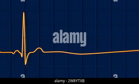 Asystole cardiac arrest, illustration Stock Photo - Alamy