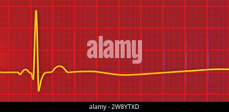 Asystole cardiac arrest, illustration Stock Photo - Alamy