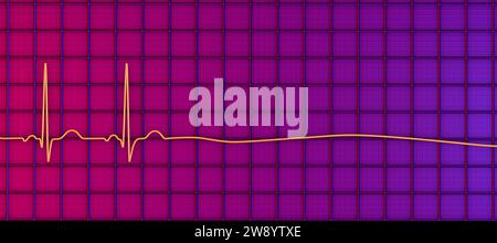 Asystole cardiac arrest, illustration Stock Photo - Alamy