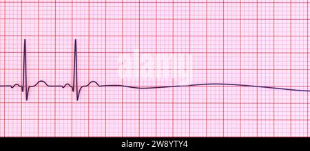 Asystole cardiac arrest, illustration Stock Photo - Alamy