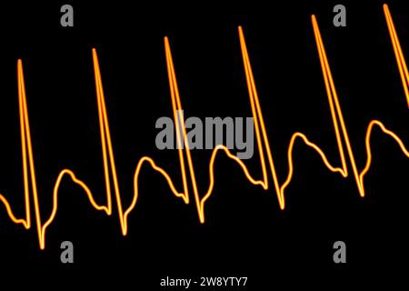 Illustration depicting an atrial flutter abnormal heart rhythm on an ...