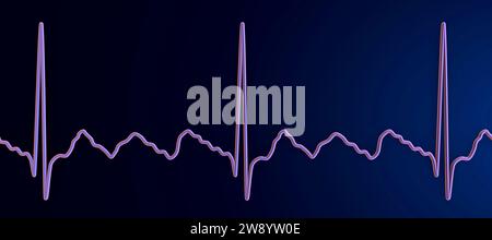 Atrial flutter abnormal heartbeat rhythm, illustration Stock Photo - Alamy