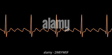 Illustration depicting an atrial flutter abnormal heart rhythm on an ...