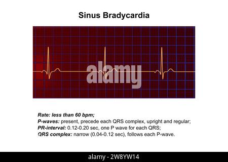 Sinus bradycardia heartbeat rhythm, illustration Stock Photo - Alamy