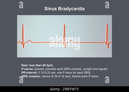 Sinus bradycardia heartbeat rhythm, illustration Stock Photo - Alamy