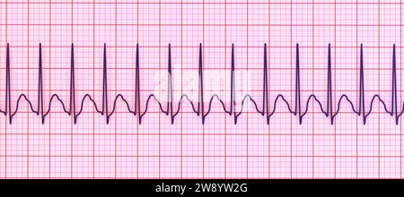 Supraventricular tachycardia heartbeat rhythm, illustration Stock Photo ...