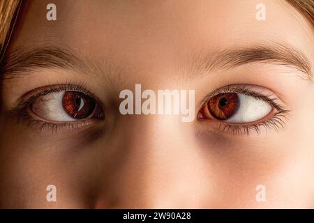 Strabismus. Little patient strabismus, treatment ophthalmic diseases ...